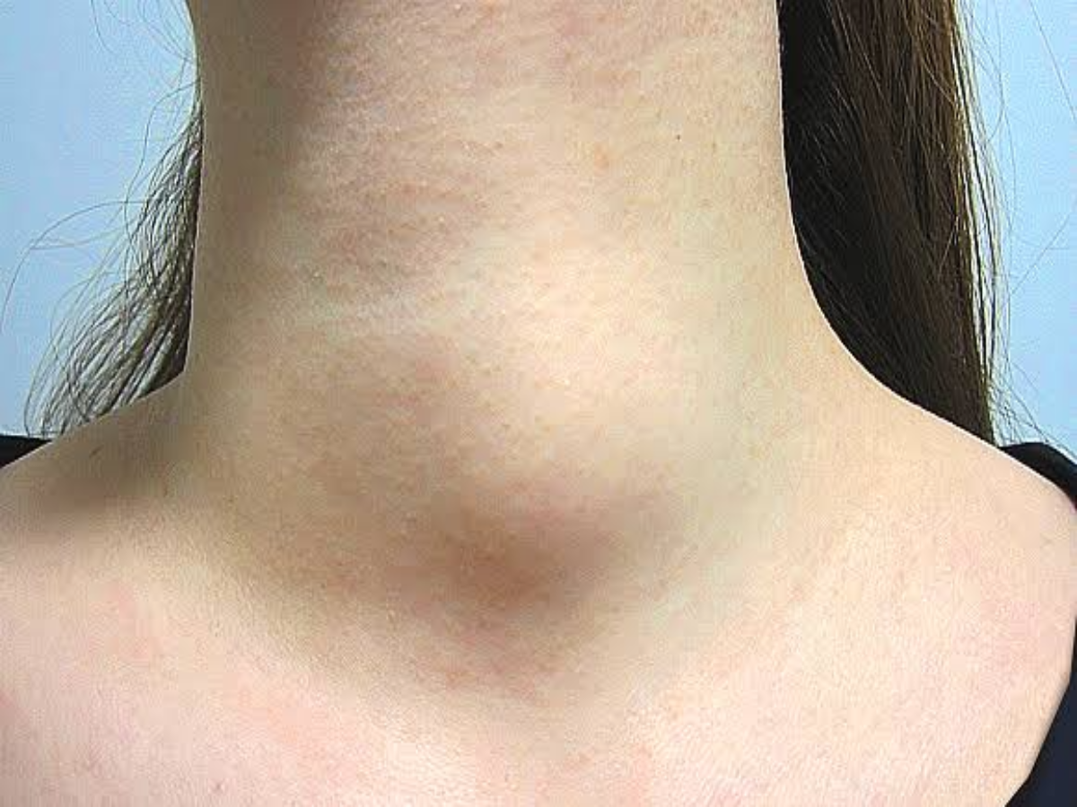 A lump in the neck can cause cancer, know its early symptoms - Times Bull
